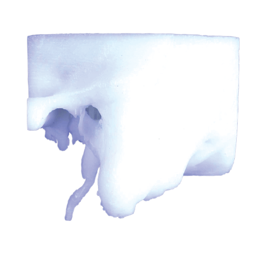 Rocher Temp'Os droit aplasie majeure sans chaîne ossiculaire